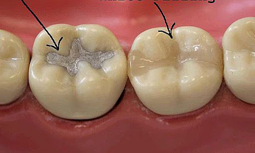 Composite Vs Amalgame - Centre Dentaire Abbassi By Dr Mohamed Kamal ...